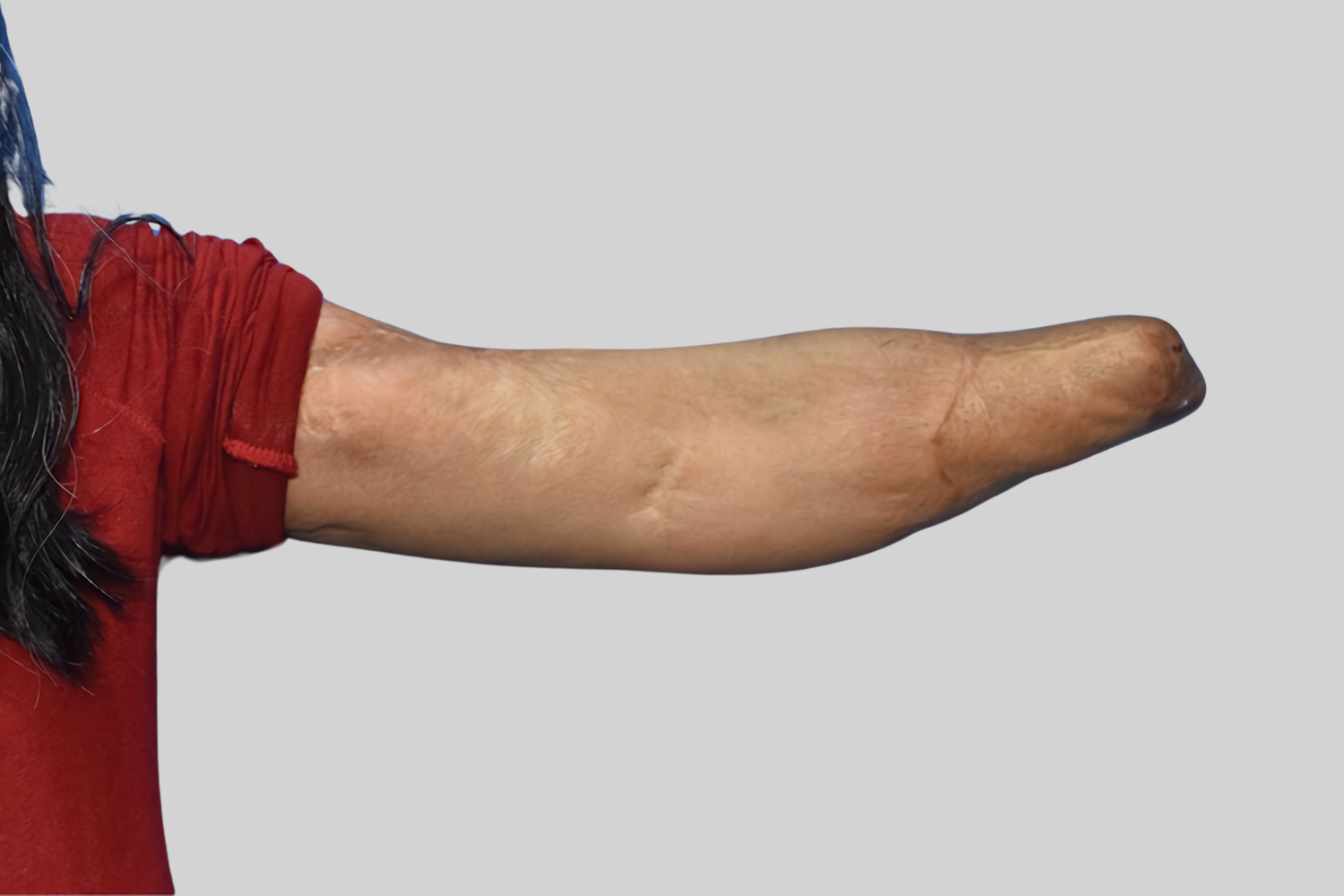 Tipos y Niveles de Amputación para Miembro Superior – CIDOP Ortopedia